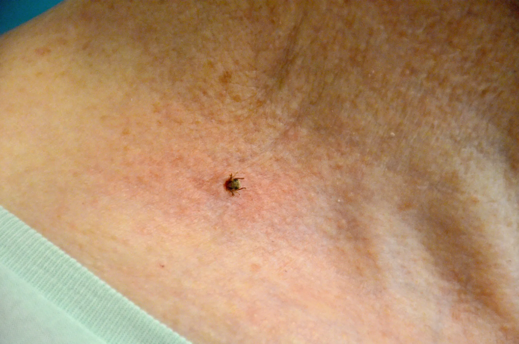 Another take on ticks: 'tis the season – The Echo